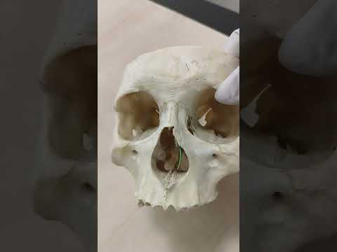 Cribriform plate of ethmoid bone