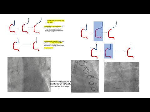 Amplatz L guide manipulations/videos- Other RCA guides and tips- The 5 RCA engagement caveats- Hanna