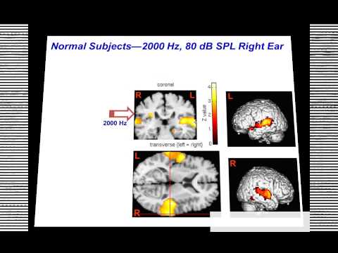 2014 Hyperacusis Research Webinar SUNY