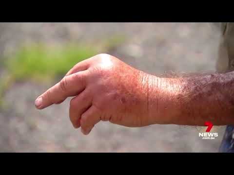 Snake Catcher bitten by a Red Belly Black Snake