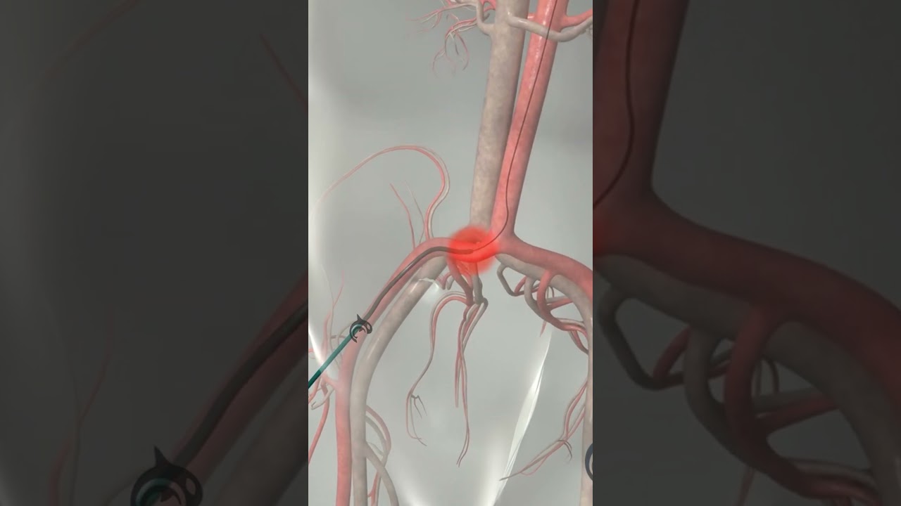 Learn How Cardiac Catheterization Works