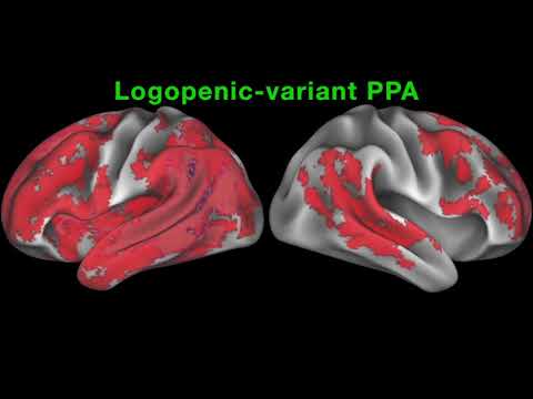Longitudinal progression of grey matter atrophy in non-amnestic Alzheimer’s disease
