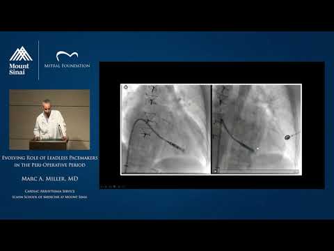 Evolving Role of Leadless Pacemakers in the Peri-operative Period