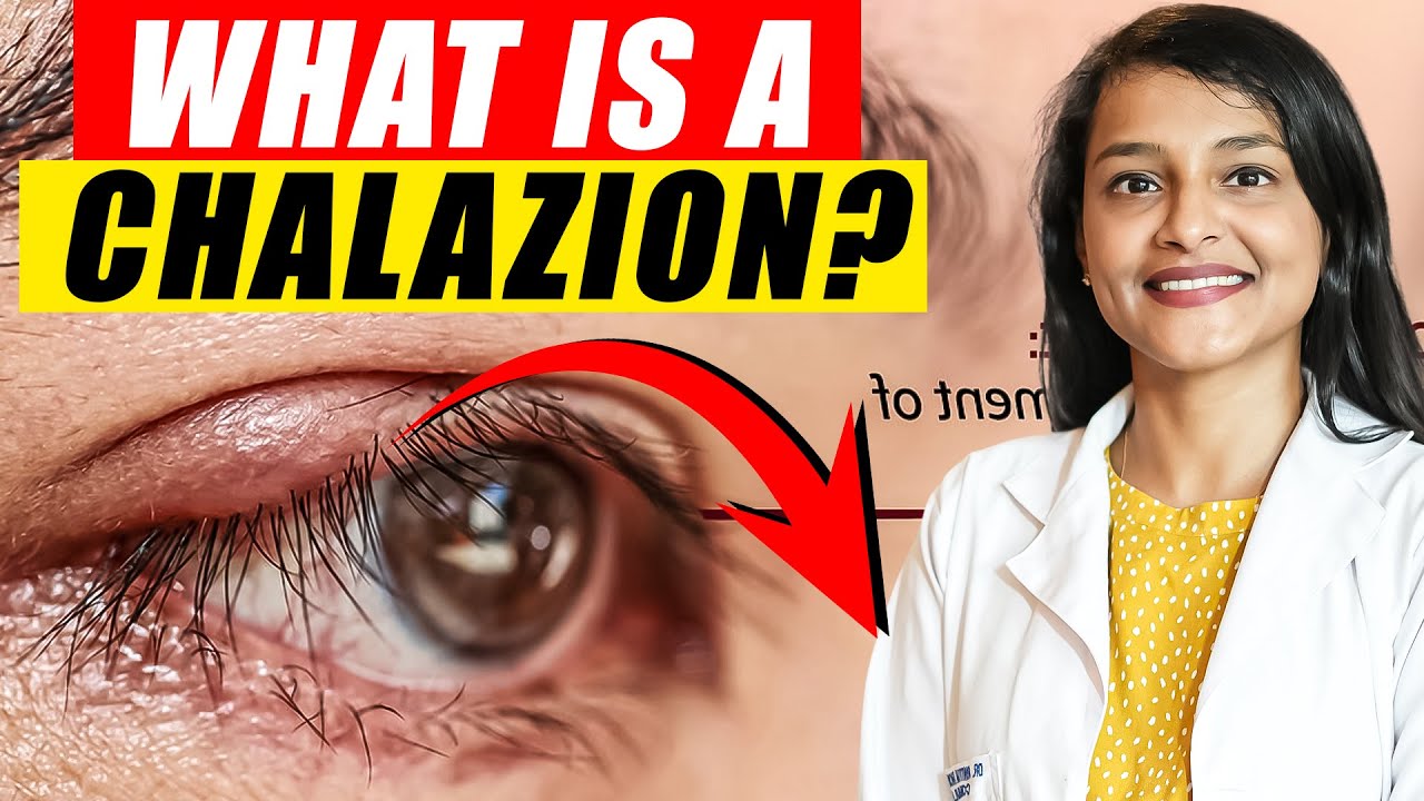 What is a Chalazion? | Chalazion Disease | Chalazion Removal | Chalazion Treatment