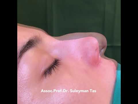 Nose Reduction Surgery w Closed Atraumatic Technique