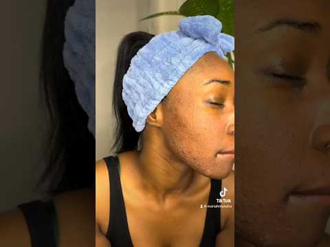 Chemical Peel | Before and After | 50% Glycolic Acid Chemical Peel At Home