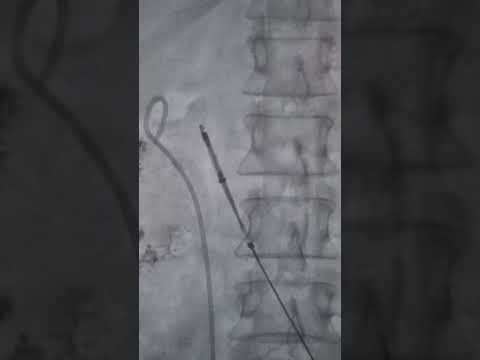 IVC filter placement (Denali)...Lt femoral access