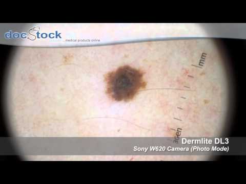 Dermlite DL3.mpg