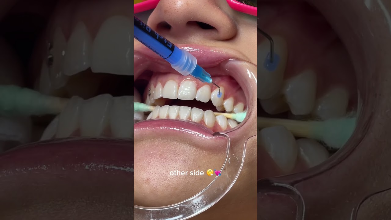 the tooth gem process 🦷💎 #toothgems #teethwhitening #teethwhiteningbusiness