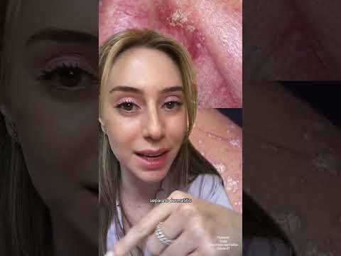 Dandruff Psoriasis And Dry Scalp #shorts