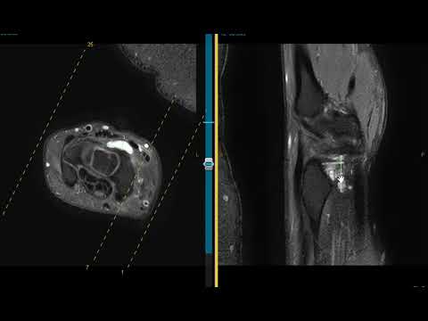 Dorsal ganglion cyst of wrist and prolapse of joint fluid over volar wrist