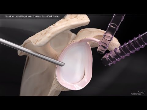 Shoulder Labral Repair with Knotless SutureTak® Anchor
