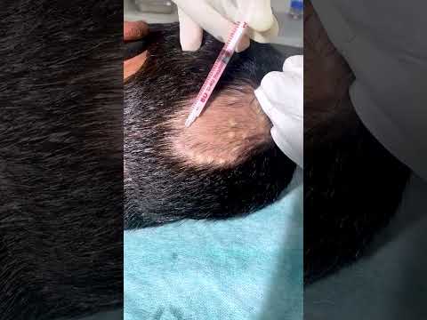 Alopecia Areata Treatment For Hair Growth | Treatment Of Alopecia | Skinaa Clinic #shorts #viral