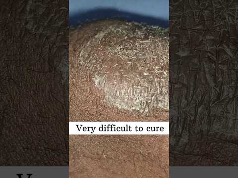 Fungal infection 😱 #skincare #fungalinfection #tinea #eczema
