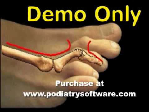 Foot Surgical Animations Part 3