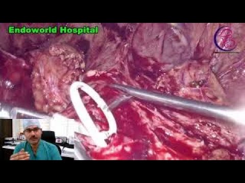 Laparoscopic ureteric reimplantation