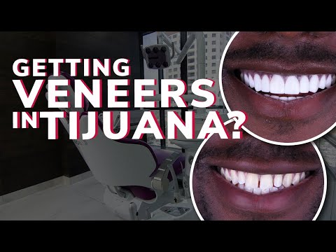 😫 I GOT 20 VENEERS IN TIJUANA MEXICO FOR $$$$!!! 💸🦷 [XDentistry Reviews]