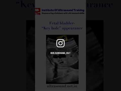 POSTERIOR URETHRAL VALVE #keyholeappearance #fetalbladder #drrandhawainstitute #OBGYNultrasound