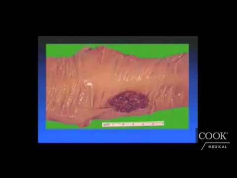 Best Protection Against Colon Cancer
