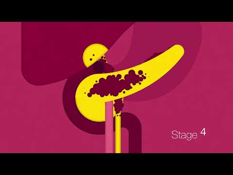 What Happens After a Pancreatic Cancer Diagnosis?