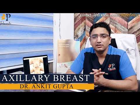 Axillary Breast or Accessory Breast Tissue - Treatment and Recovery for Axillary Breast!