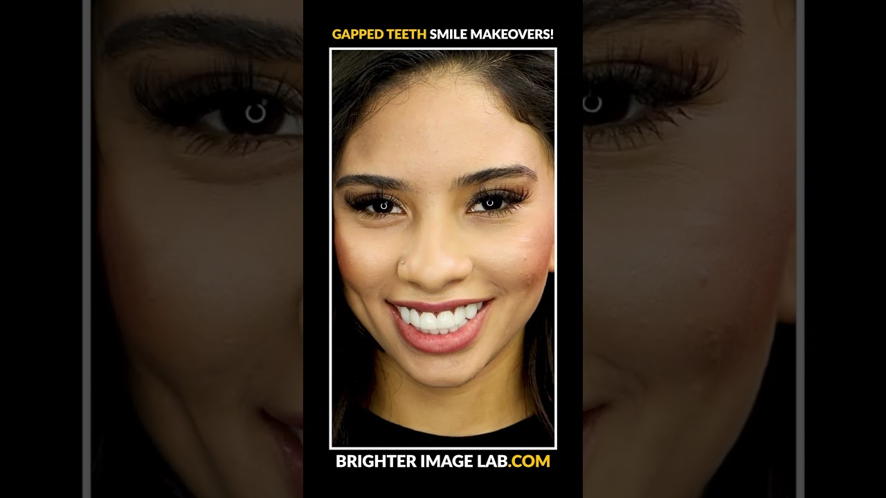 How to Fix Gapped Teeth! Brighter Image Lab Dental Veneers! #shorts