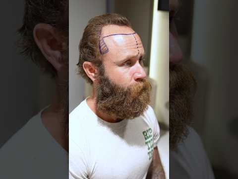 Cosmedica Clinic Hair Transplant in Turkey #shorts #hairtransplant #video