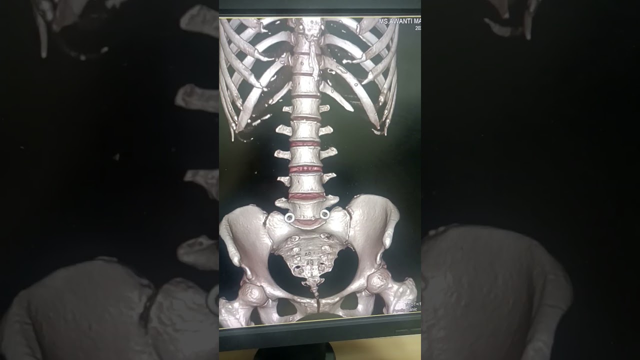 ct LS spine 3d image#