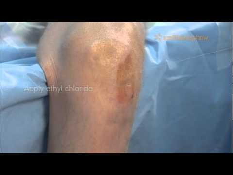 Ponction ou infiltration du genou · Rhumatologie