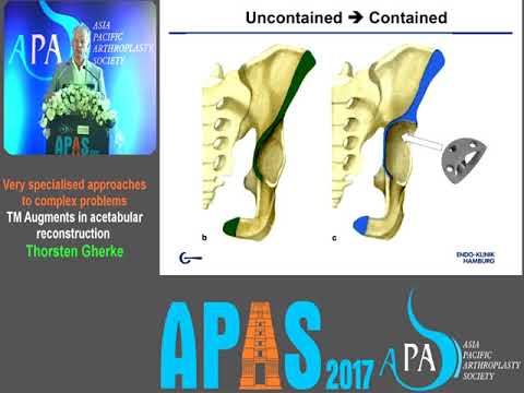 APAS 2017 DAY 3 77 - OrthoTV