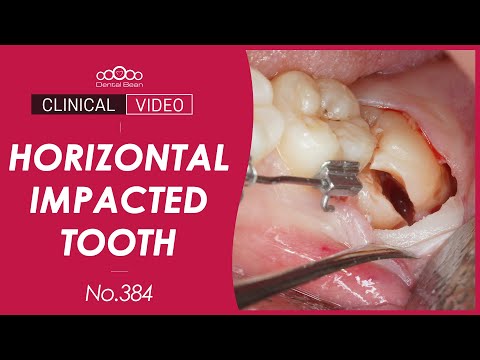 Extraction of a horizontally impacted tooth [Dr. Cho Yongseok]