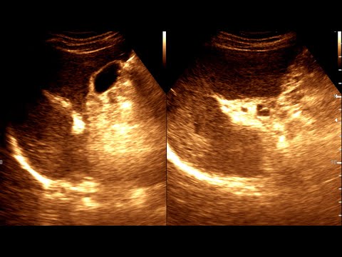 Chronic Liver Disease | Cryptogenic hepatitis