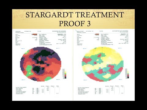 Stargardt Macular Dystrophy Treatment Proof – Visual Field Tests Results