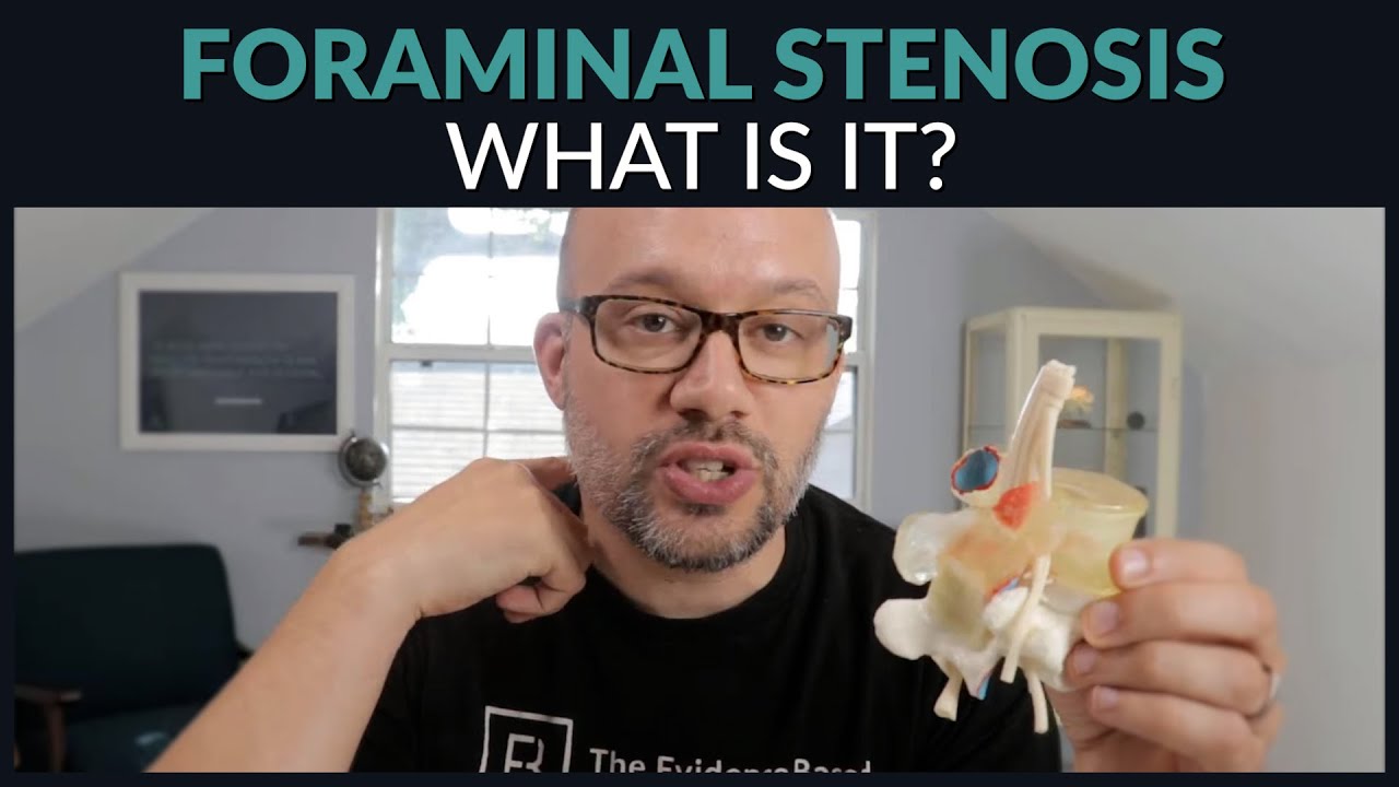 What is Foraminal Stenosis & How to Find Relief