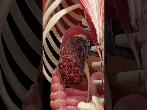 Polycystic Kidney Disease (PKD) | 3D Medical Animation #anatomy #medicalanimation