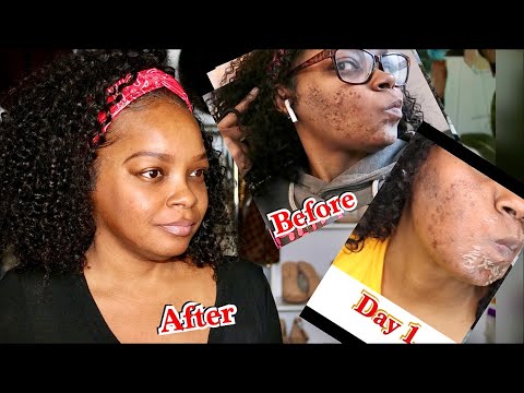CHEMICAL PEEL FOR HYPERPIGMENTATION/MELASMA | BEFORE & AFTER