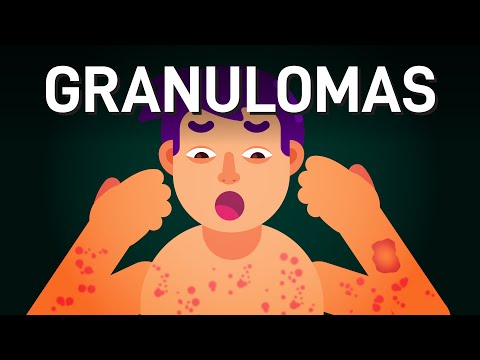Granuloma | The Losing Battle Against Invaders