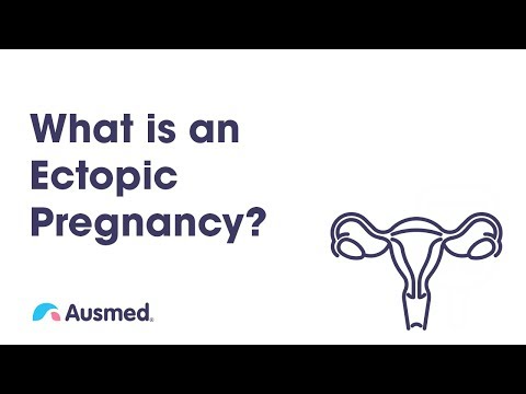What is an Ectopic Pregnancy? | Ausmed Explains...