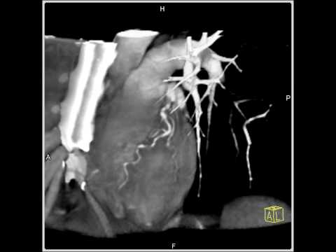 Cardiac: Normal LAD motion