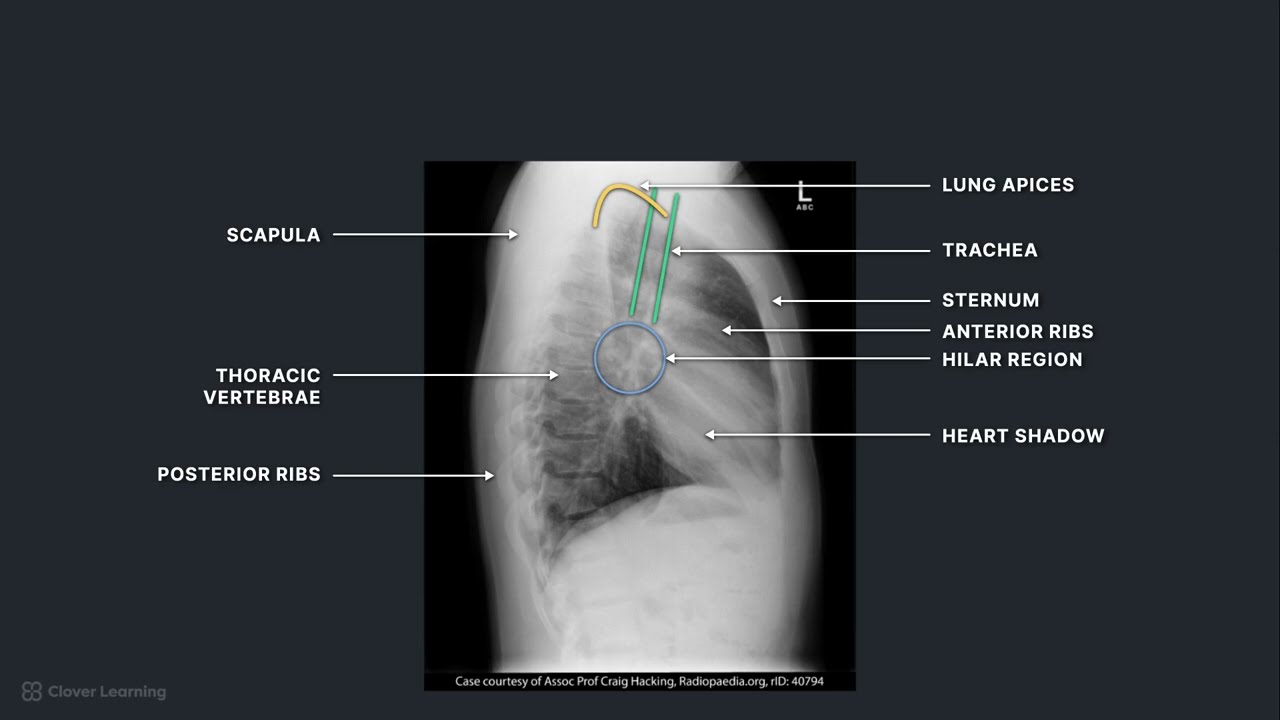 How to Recognize Key Anatomy on Chest Radiographs