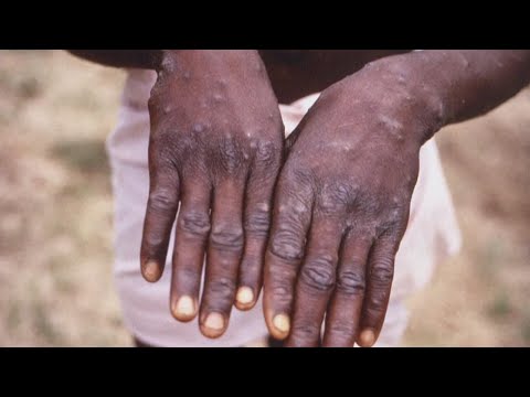 US officials announce 'aggressive' steps against monkeypox outbreak