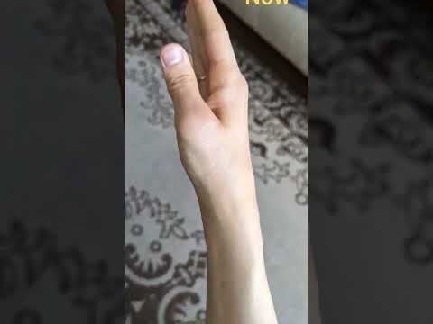 Before and After Rheumatoid Arthritis - Aljona's Wrists