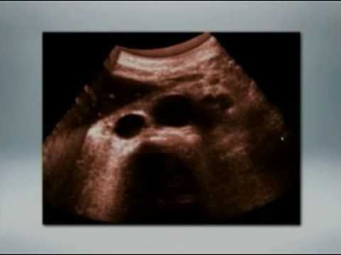 3D Sonography in the Abdomen