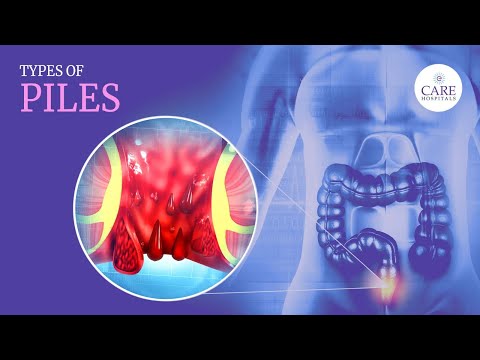 What are Hemorrhoids(Piles) | What are the Types of Piles | How to Diagnose Piles?| बवासीर
