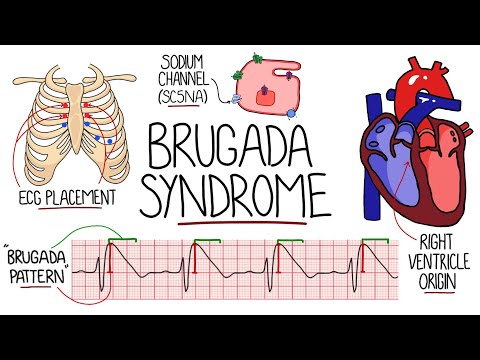 Brugada Syndrome Explained (Includes ECG) - "Sudden Unexplained Nocturnal Death Syndrome"