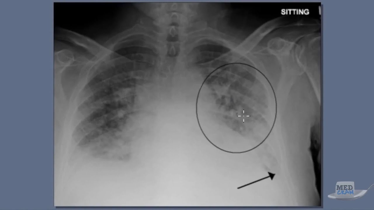 CME365 Presents Pulmonology Explained Clearly