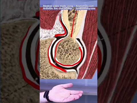 Medication for rheumatoid arthritis not working, what's next...