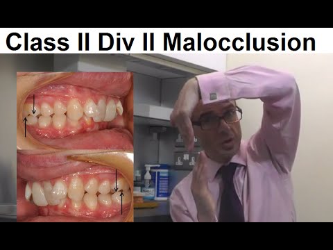 Why Class II Division II Malocclusion/ Inclined Teeth is Less Common in People by Dr Mike Mew