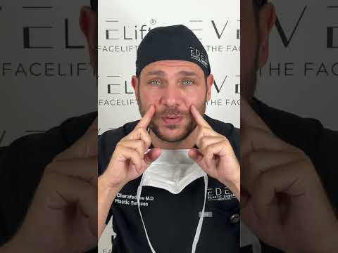 51-Year-Old EVE Lift™ Patient Before and 24 Hours After | Dr. Ali Charafeddine, MD