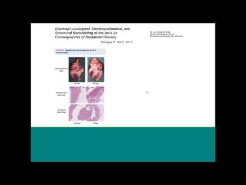A Fib Prevention by Dr  Andrew Corsello of MMP Cardiology 20160429 1555 1